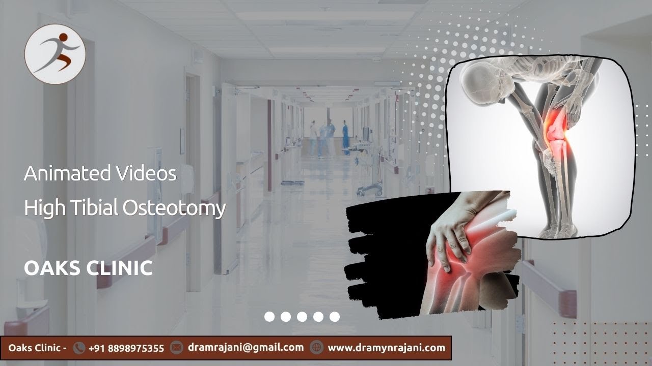 Animated High Tibial Osteotomy Surgery (HTO) | Knee Surgery | Dr. Amyn ...
