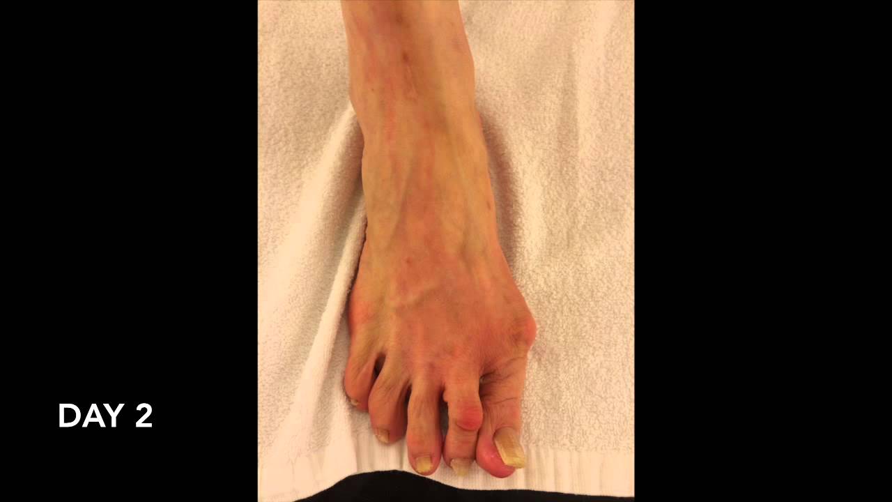Non Surgical Correction of Severe deformed feet - YouTube