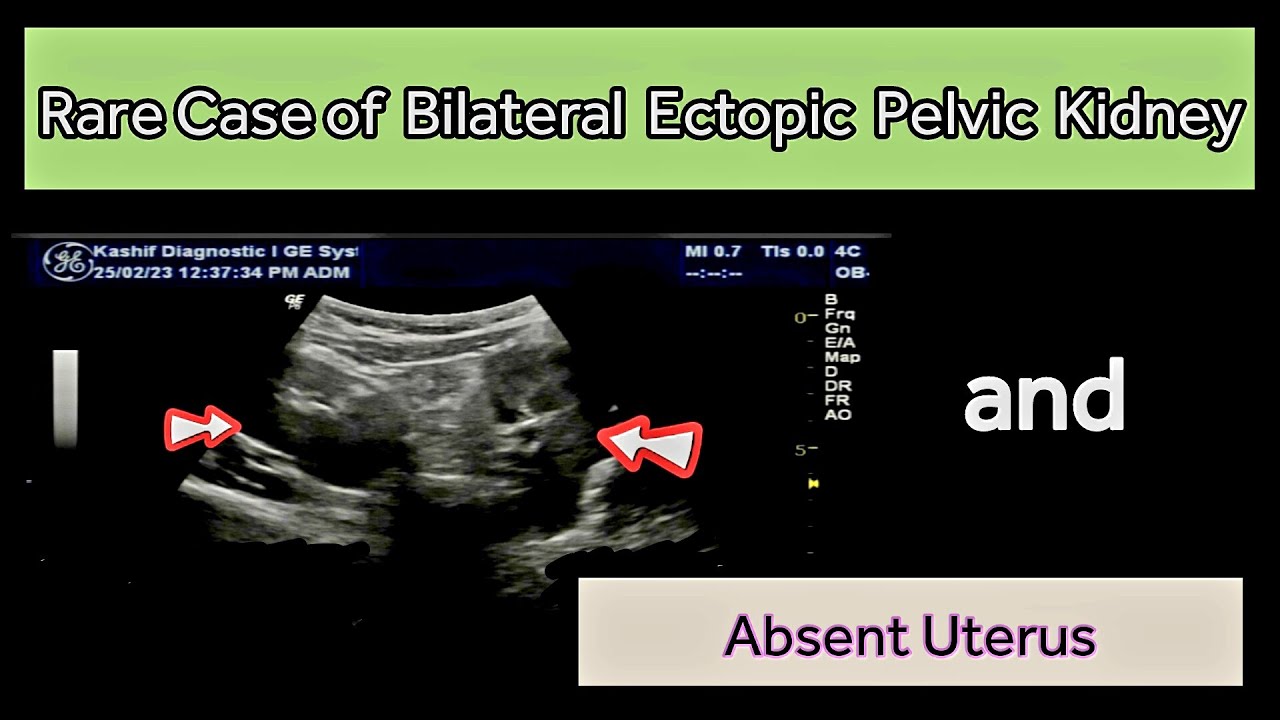 Rare Ultrasound case of Bilateral Ectopic Kidneys and Absent Uterus in ...