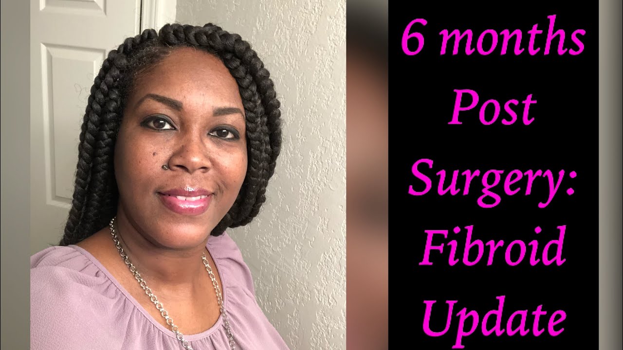 6 months Fibroid Update: Post Ablation Surgery - YouTube