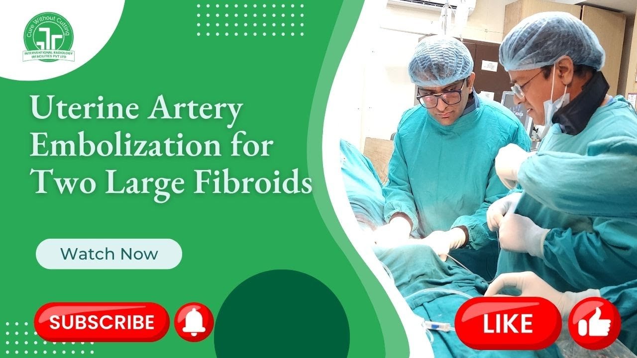 Uterine Artery Embolization for Two Large Fibroids | Dr. Sandeep Sharma ...