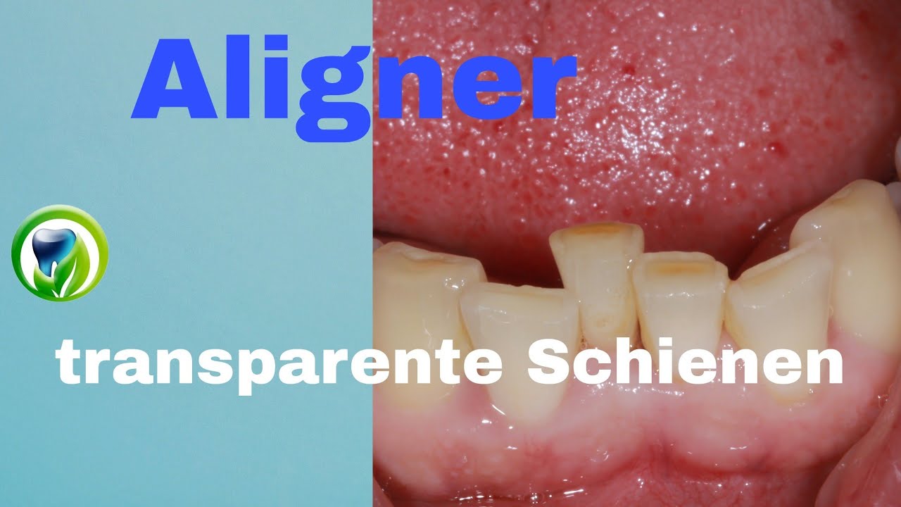 Aligner - unsichtbare Schienen zur Zahnregulierung | Zähne einordnen ...