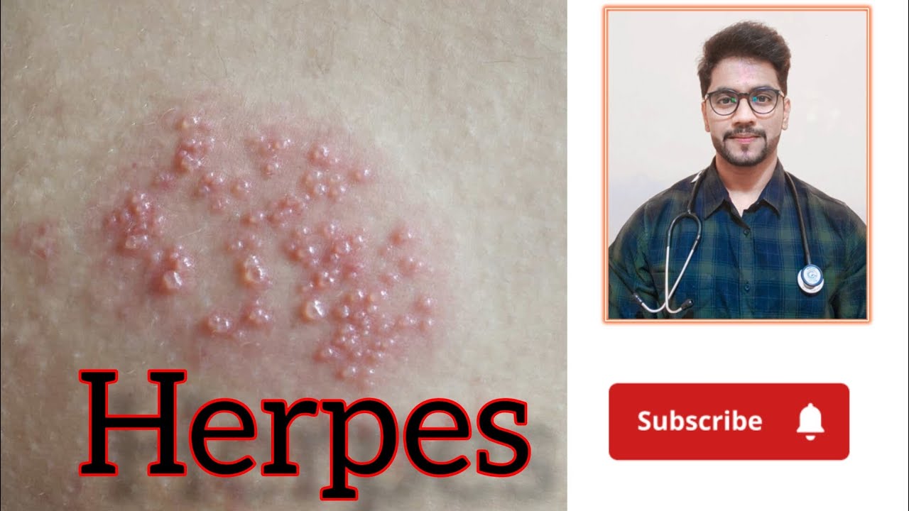 Herpes Zooster causes, symptoms, treatment #herpesvirus # ...