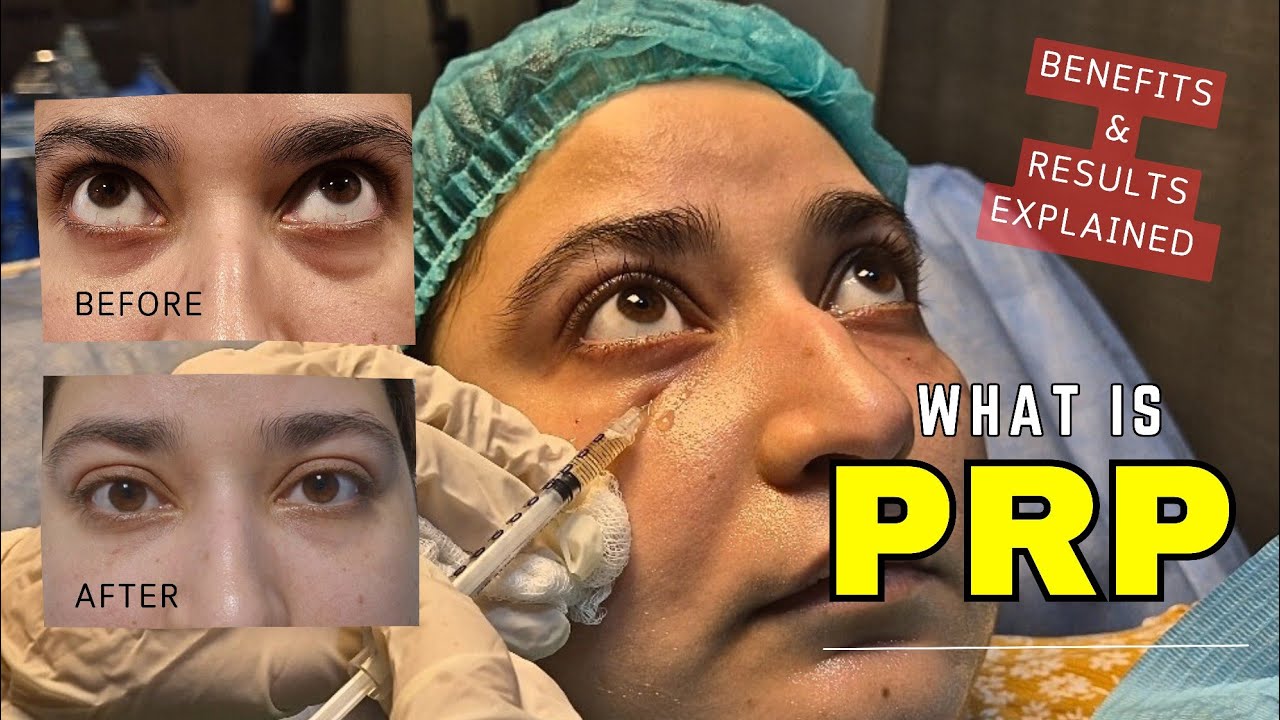 Trying Under Eye PRP Treatment | Dark Circles Treatment Review (Part 1 ...