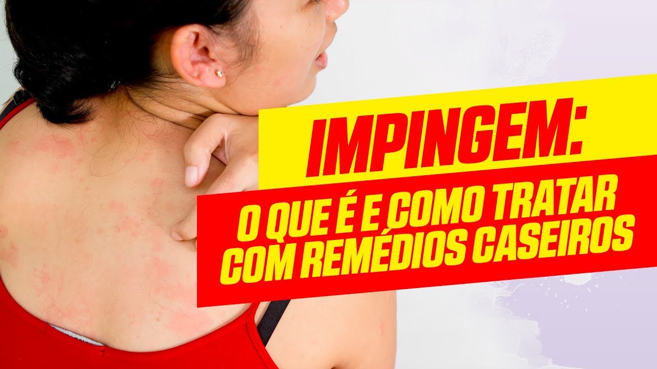 Impingem: o que é e como tratar com remédios caseiros - YouTube