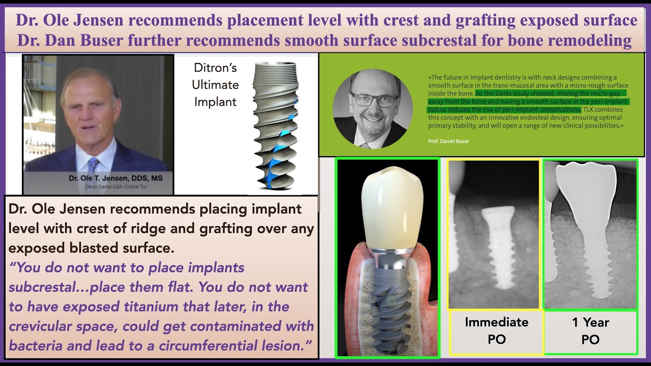 Dr. Ole Jensens and Dr. Buser Recommend not leaving blasted surfaces ...