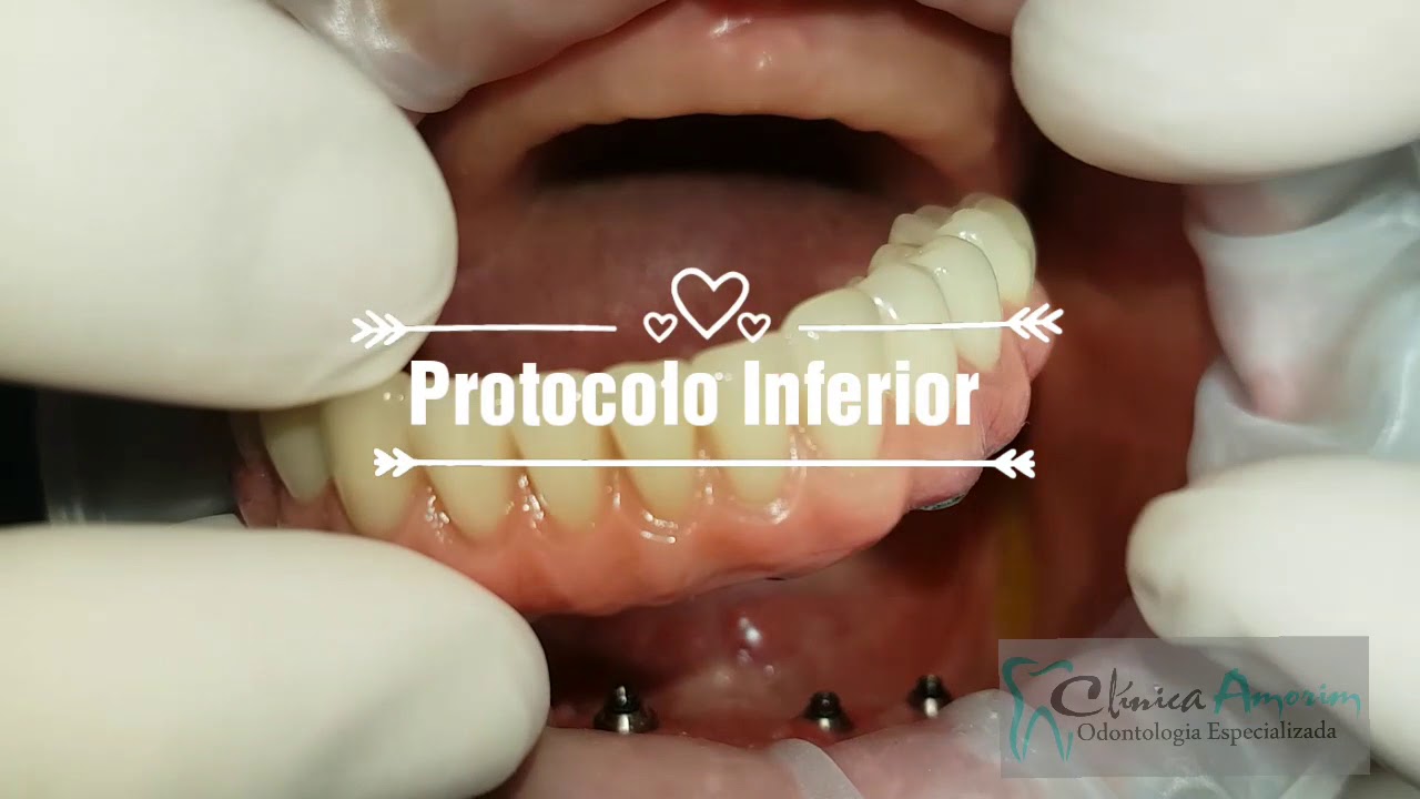 Instalação de Prótese Total Superior e Protocolo Inferior (Dr.Glauco ...