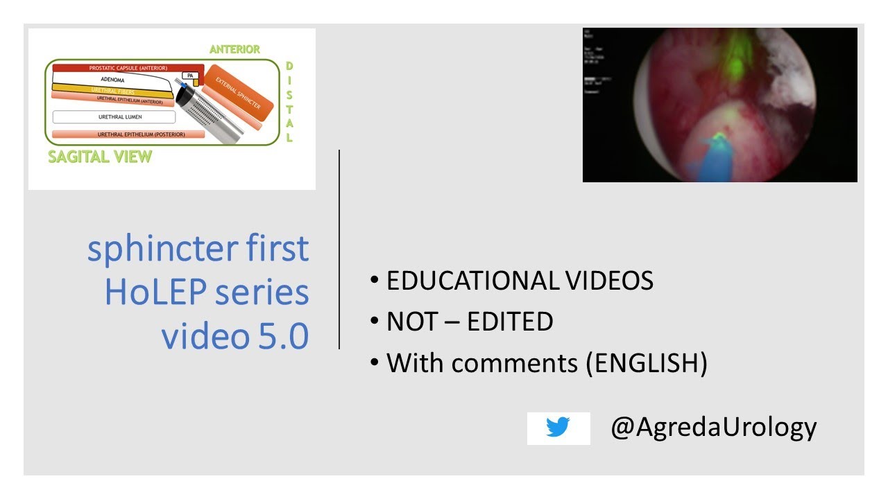 sphincter first HoLEP v5.0 (very large intravesical lobe, done in 20min ...
