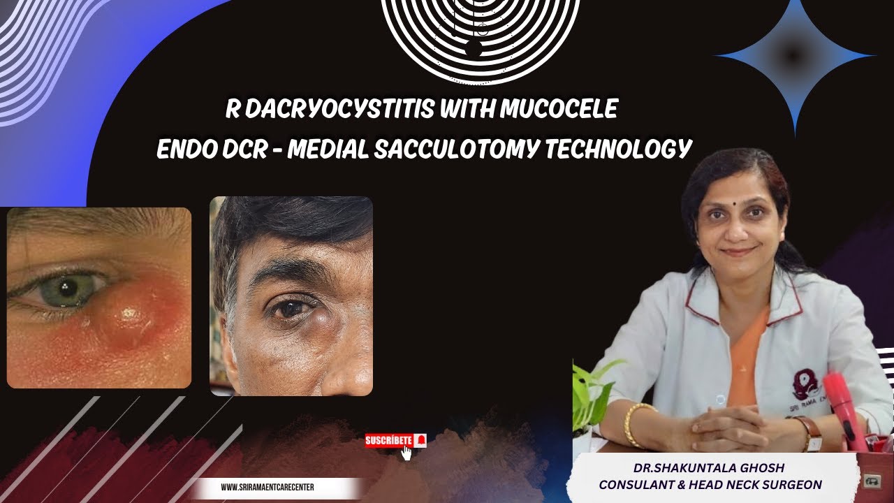 R DACRYOCYSTITIS WITH MUCOCELEENDO DCR - MEDIAL SACCULOTOMY TECHNOLOGY ...