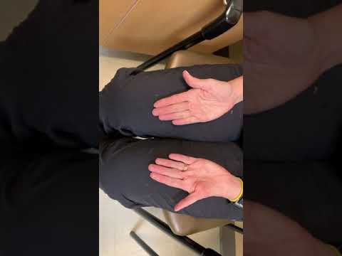 Hypoplastic (small) thumb- what it looks like in an adult. | Congenital ...