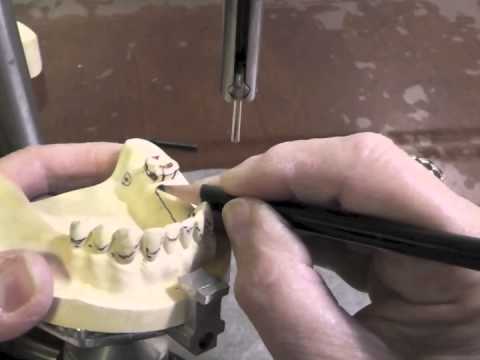 R P D Design - Ken Class II Mand Dentoform Cast Part D - YouTube