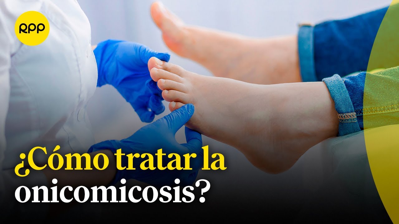 ¿Qué son las onicomicosis o infecciones de las uñas? | Espacio vital ...
