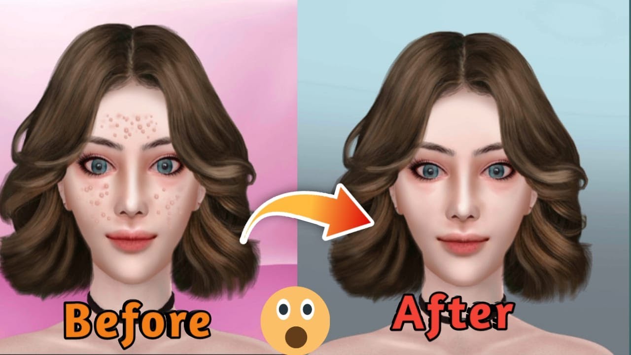 ASMR Acne Removal Treatment | Acne Removal Animation | Stisfying and ...