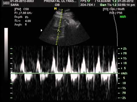 El latido del corazon de mi Bebe Hermoso 2da Parte. - YouTube