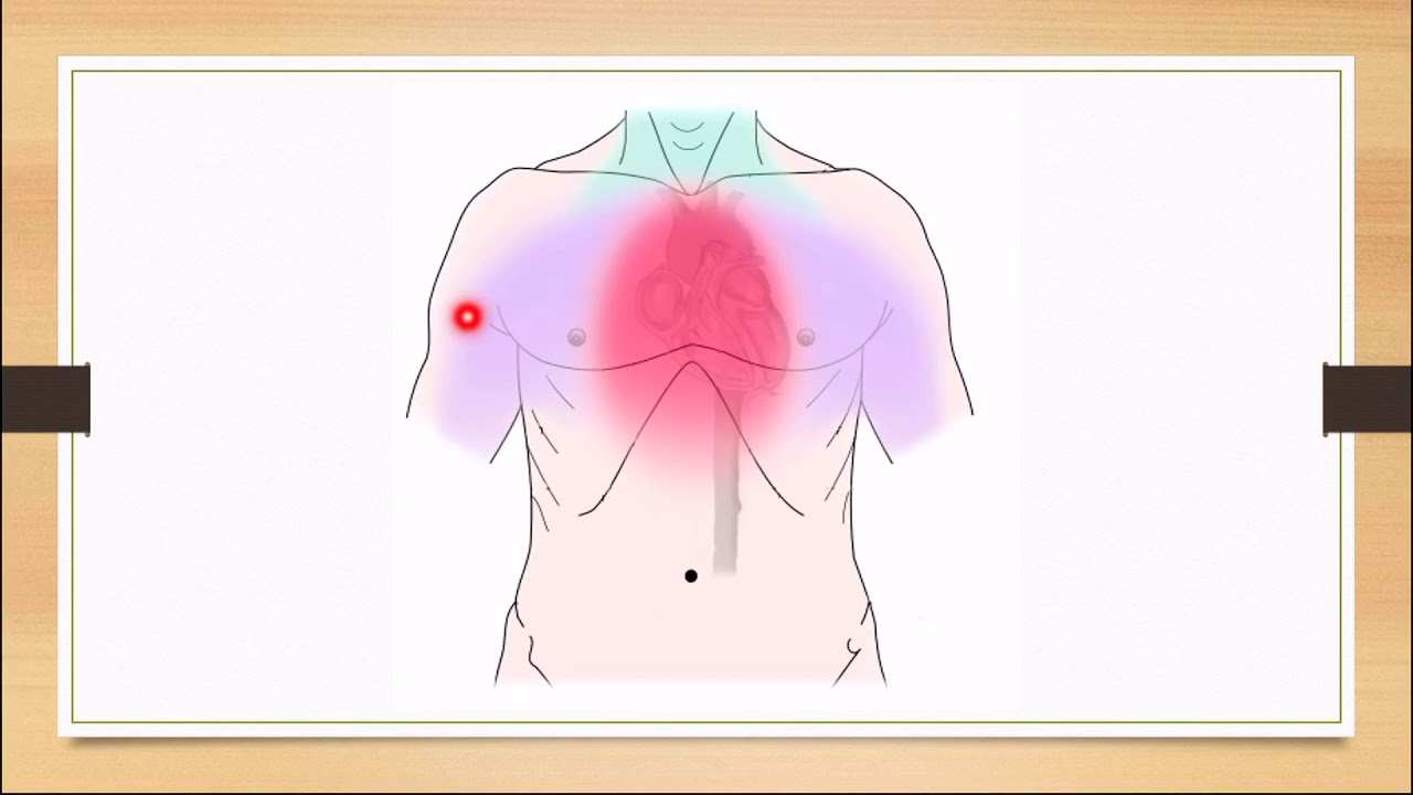 2 History Of Present Illness chest Pain YouTube 2-history-of-present-illness-chest-pain-youtube