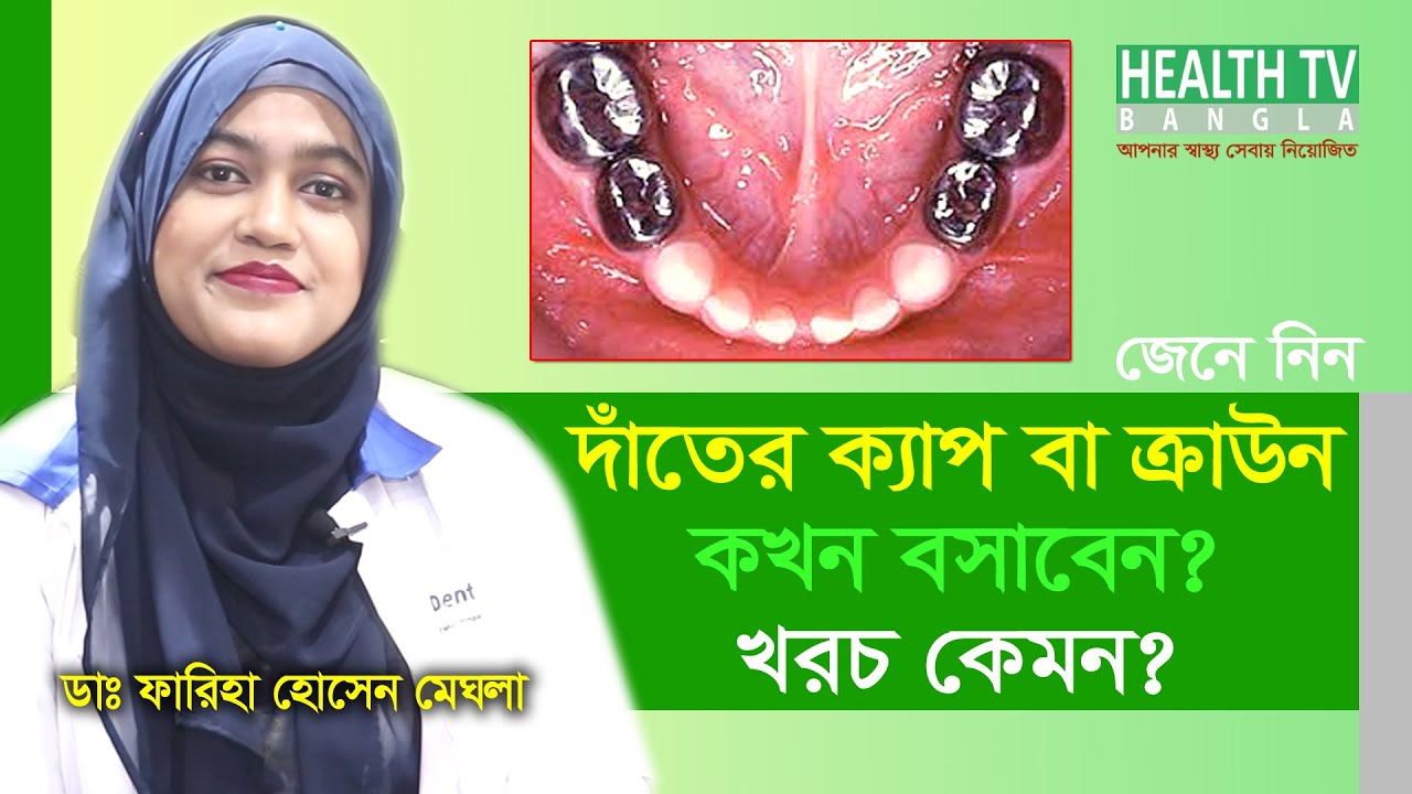 দাঁতের ক্যাপ বা ক্রাউন - কোনটা ভালো? কখন বসাবেন? খরচ কেমন? Teeth Cap ...