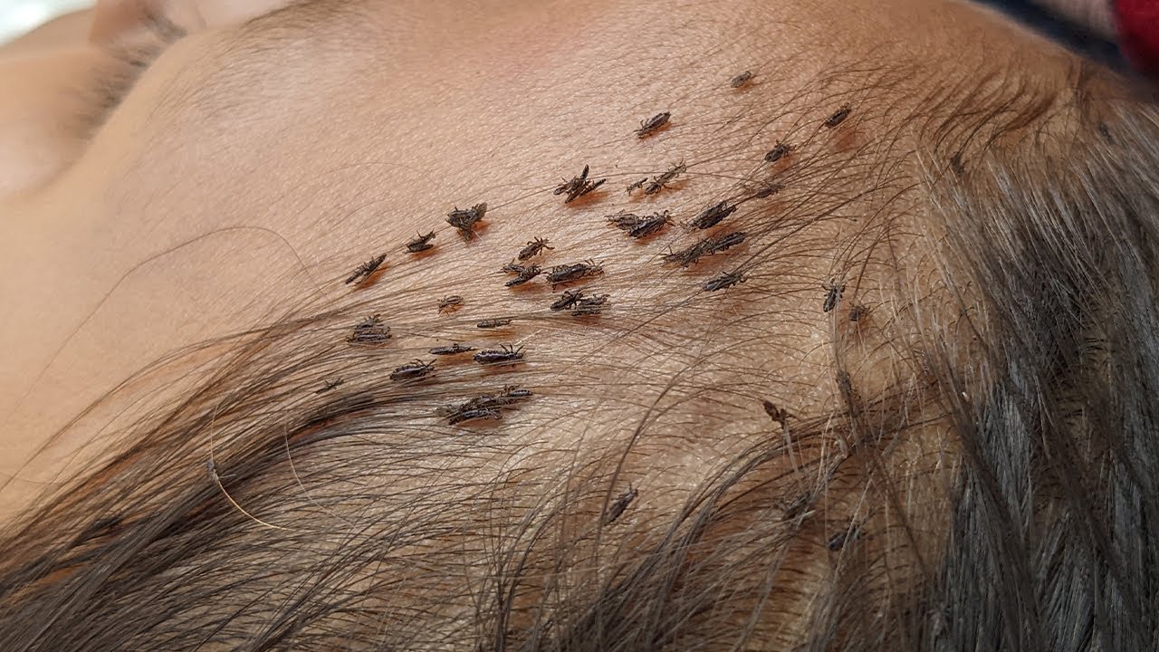 How to remove head lice and nits - Pluck million head lice out of head ...