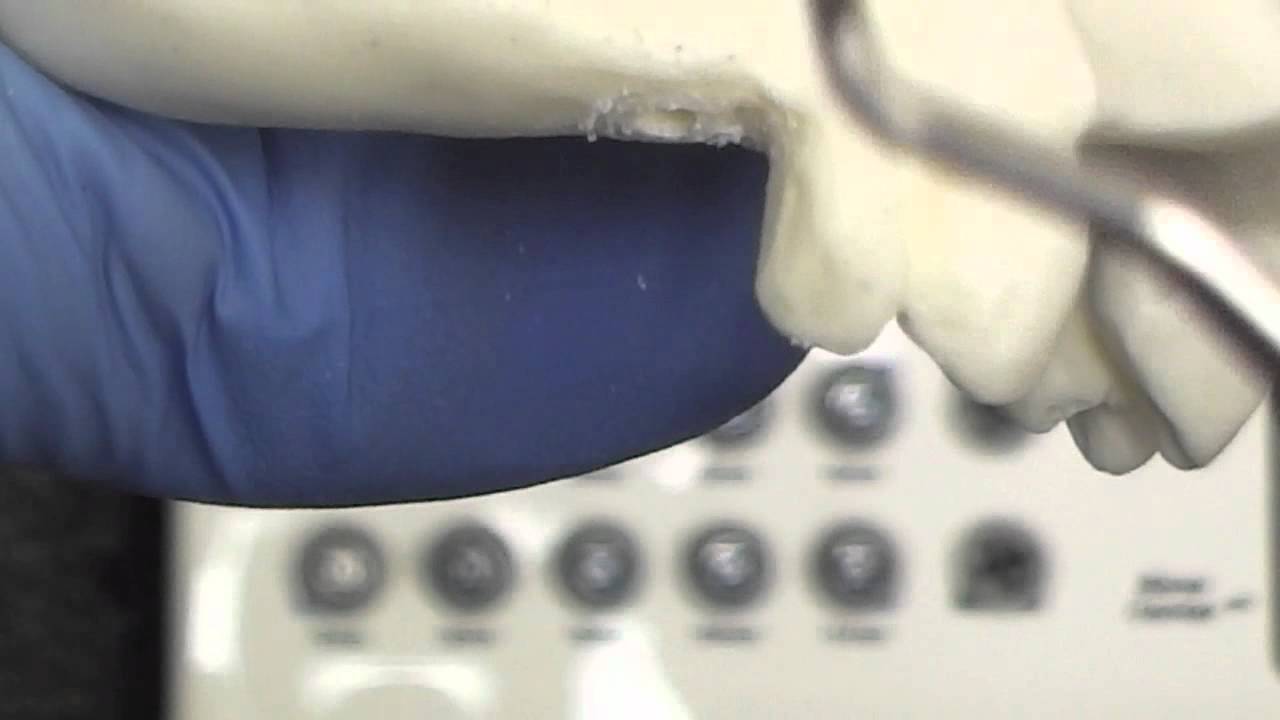 Hammerless Crestal Sinus Lift Technique Part 1 - YouTube