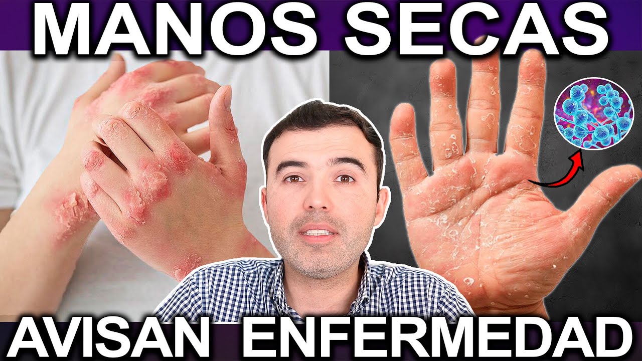 PIEL SECA! Tu Cuerpo Te Está Avisando Causas Enfermedades Tratamientos ...