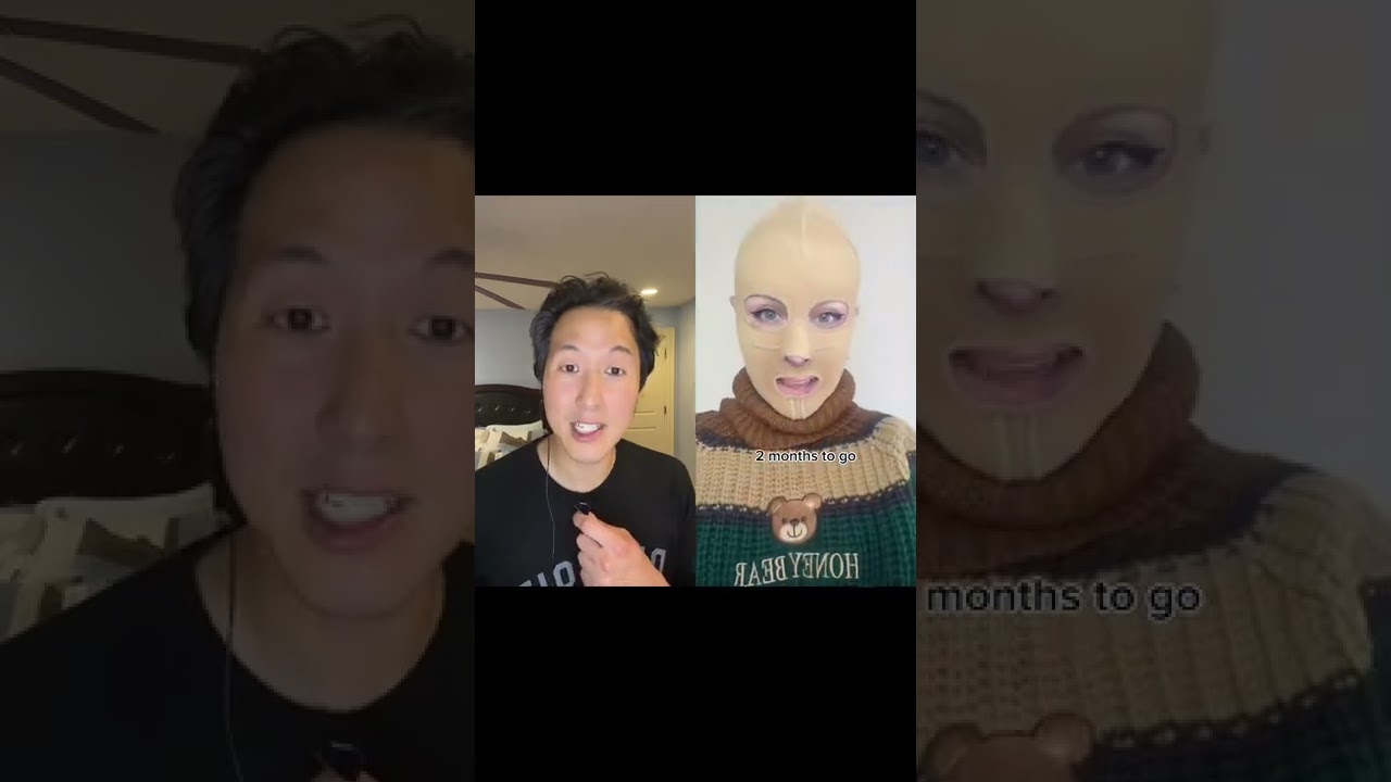 Face Reveal After Severe Burns- What an Inspiration! #shorts # ...