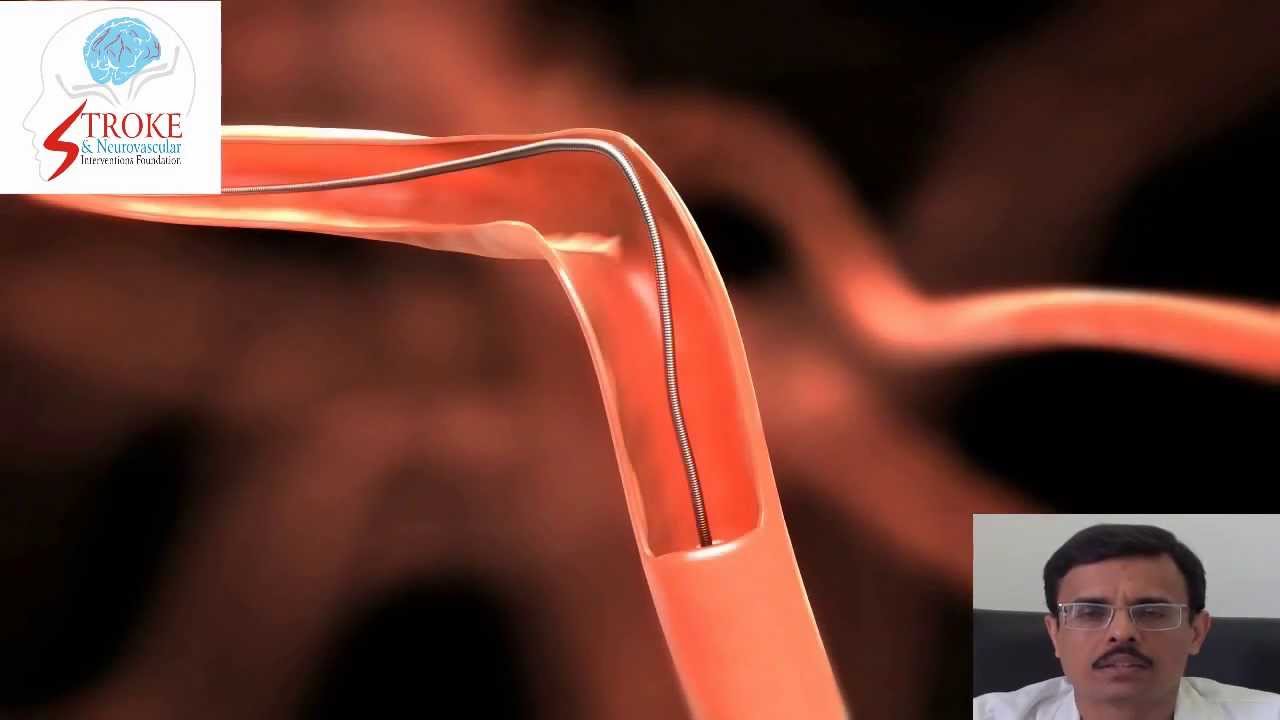Mechanical Clot Removal In Acute Stroke Using Solitaire Device (Hindi ...