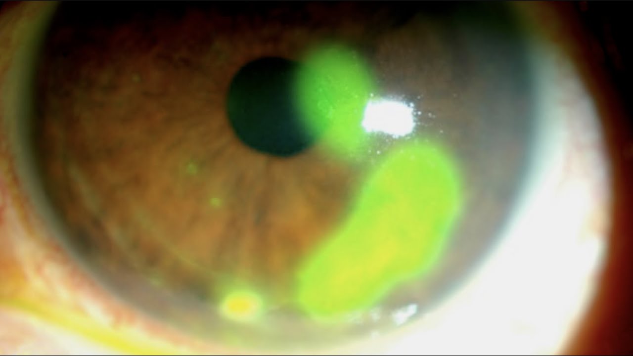 Ulcera corneal traumática y herpética - YouTube