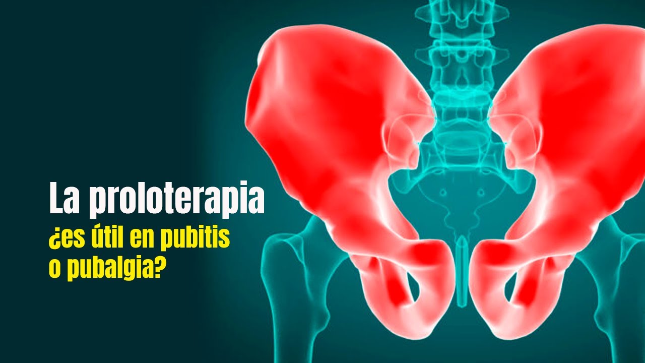 La proloterapia ¿Es útil en pubitis o pubalgia? - YouTube