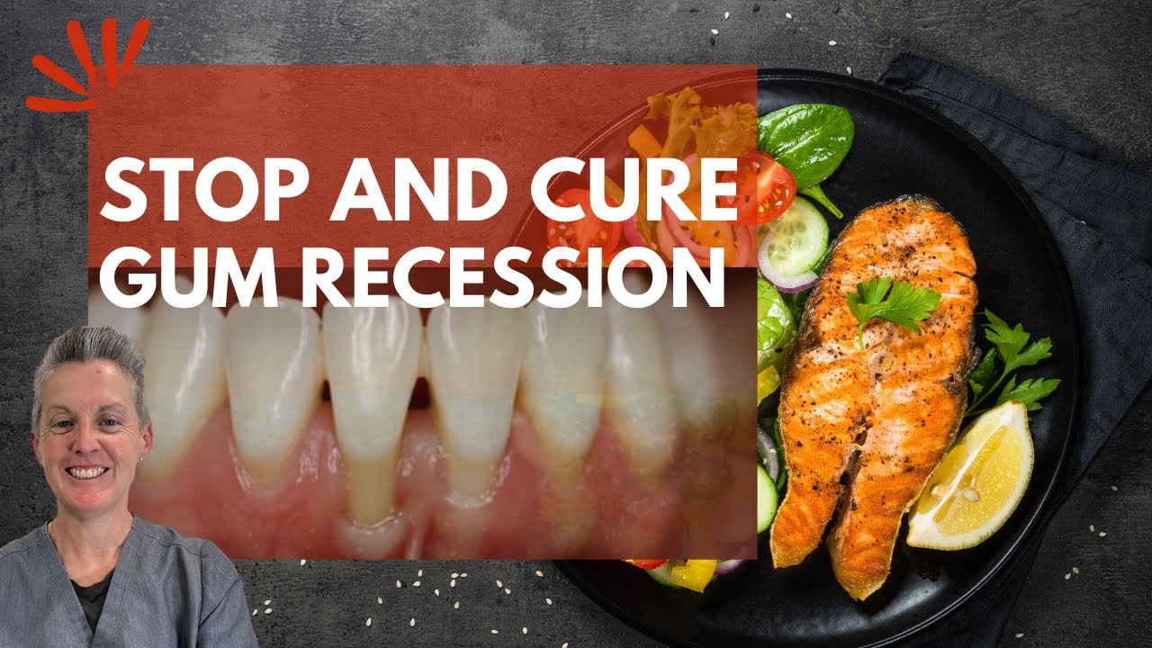 Do This To Stop Receding Gums & Gum Disease Using These Powerful Foods ...