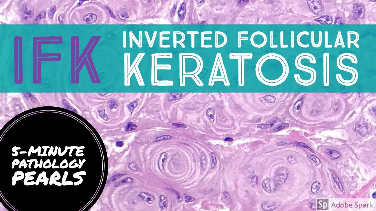 IFK (Inverted Follicular Keratosis): 5-Minute Pathology Pearls - YouTube