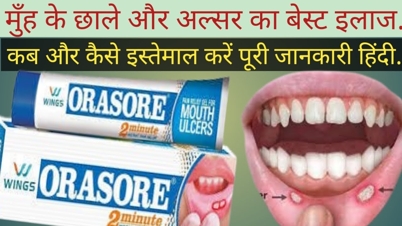 Orasure mouth gel ke Fayde. Orasure gel Uses in Hindi. Mooh ke Chhale ...