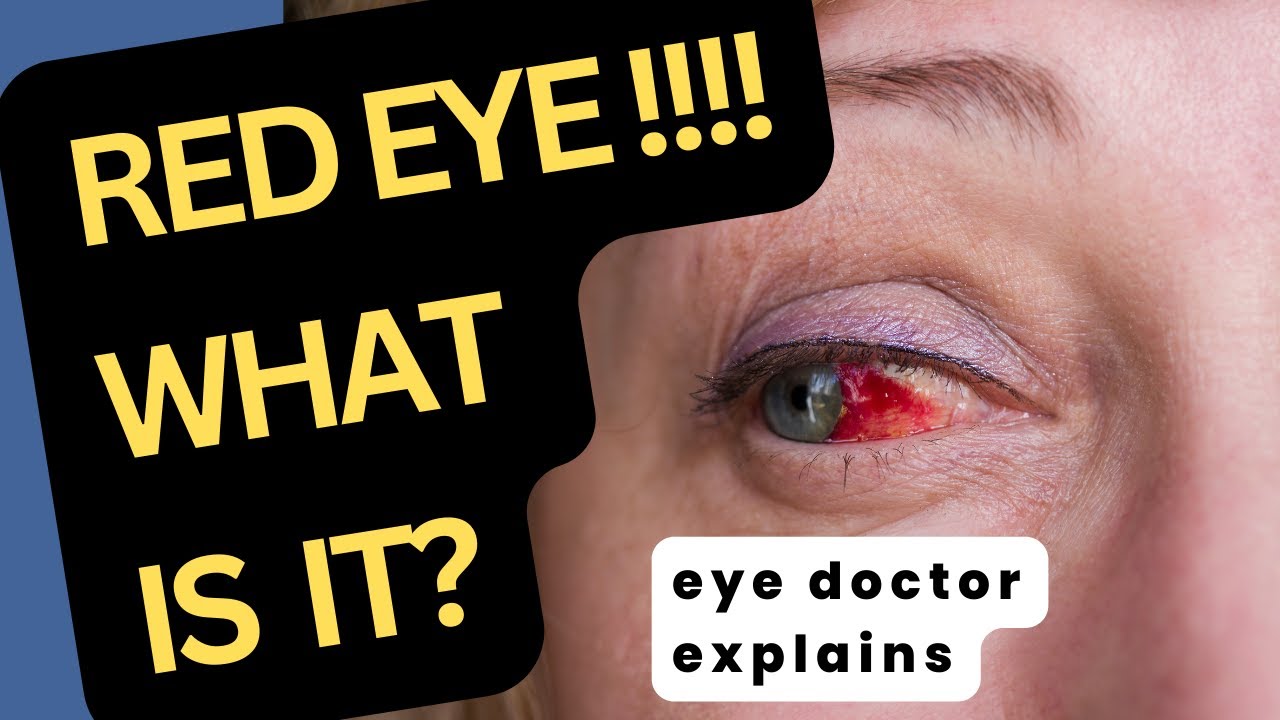 Sudden BLOODSHOT Eye Pain Vs No Pain Why Are My Eyes Bloodshot Sudden BLOODSHOT Eye Pain Vs No Pain Why Are My Eyes Bloodshot