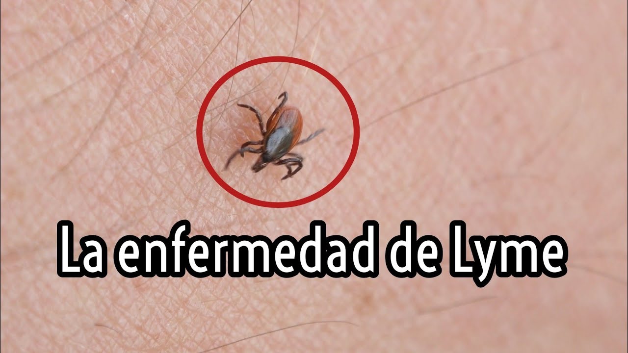 La enfermedad de Lyme | Sintomas y tratamiento / Sabias que? - YouTube