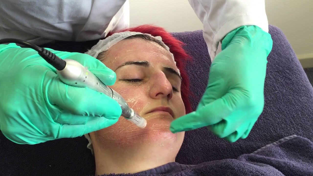 Derma FNS Training Video by Skinmed - YouTube