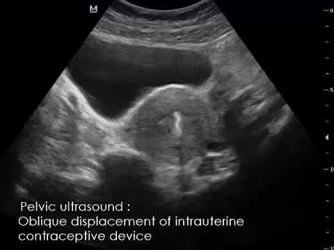 CASE 780 Oblique displacement of intrauterine contraceptive device ...