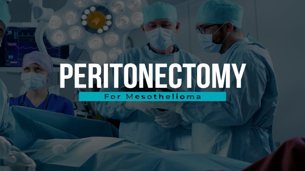 Peritonectomy for Mesothelioma | Mesothelioma Hope - YouTube