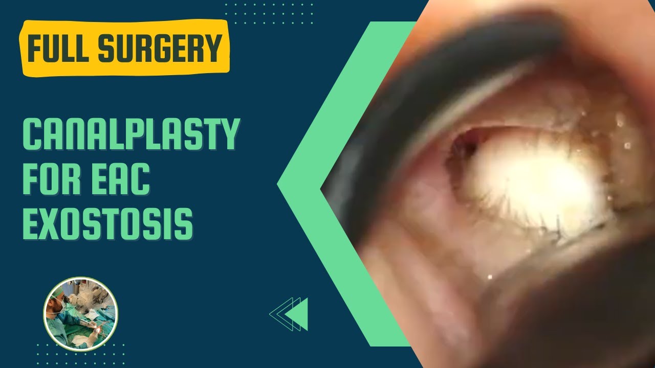 Canalplasty for EAC Exostosis - Transcanal Approach - Full-Length ...