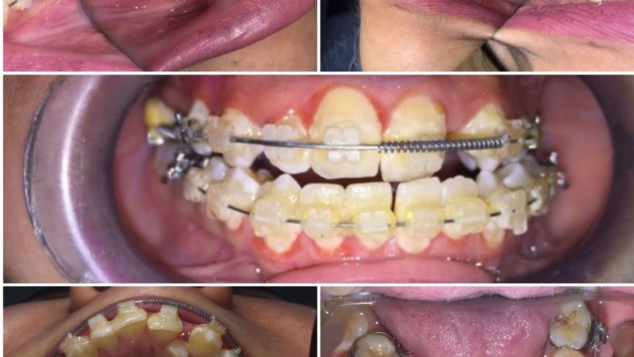 Transferred ortho case bimax + anterior and posterior crossbite after ...