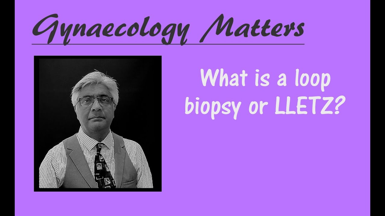 What is a loop biopsy of cervix or LLETZ? - YouTube