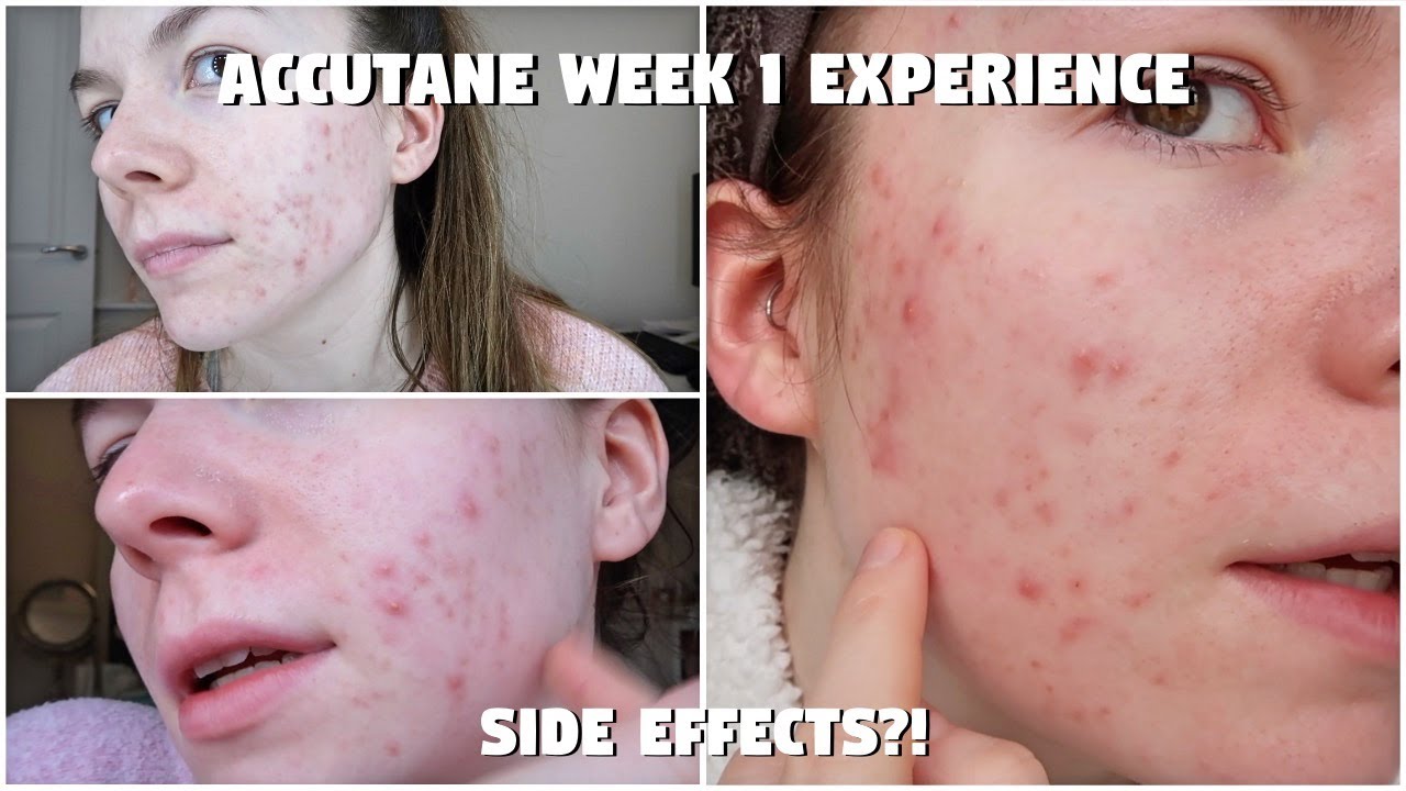 My Accutane Experience FIRST WEEK | Days 1-7 on Isotretinoin | Acne ...