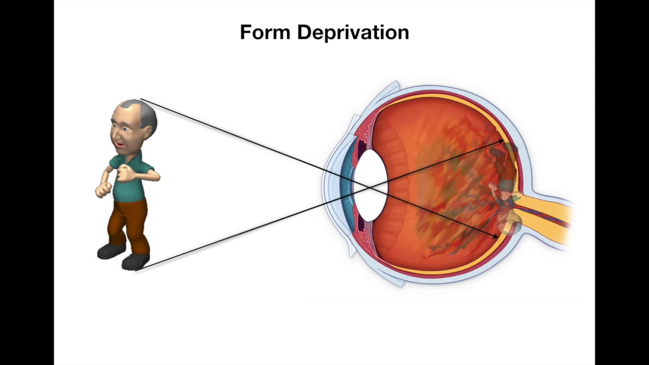 Myopia post Form Deprivation - YouTube
