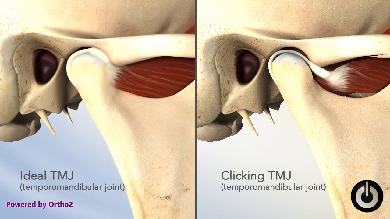 TMJ Clicking - YouTube