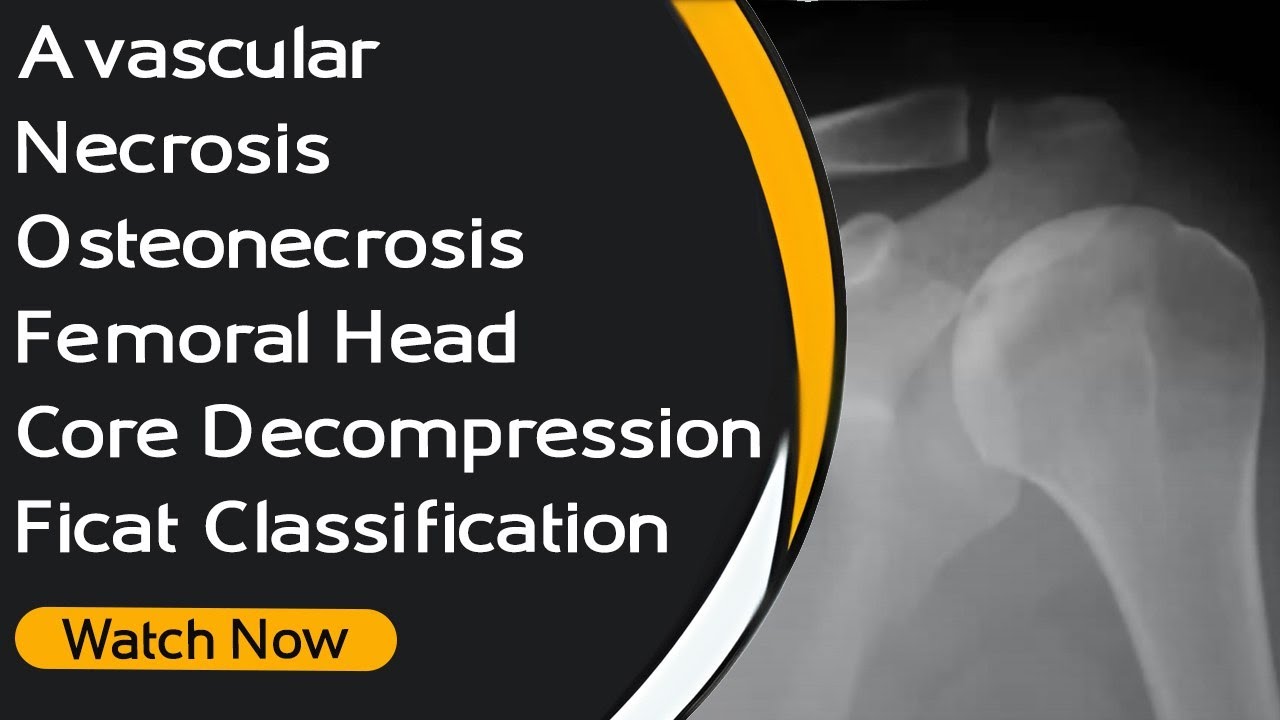 Avascular Necrosis / Osteonecrosis | Femoral Head | Core Decompression ...