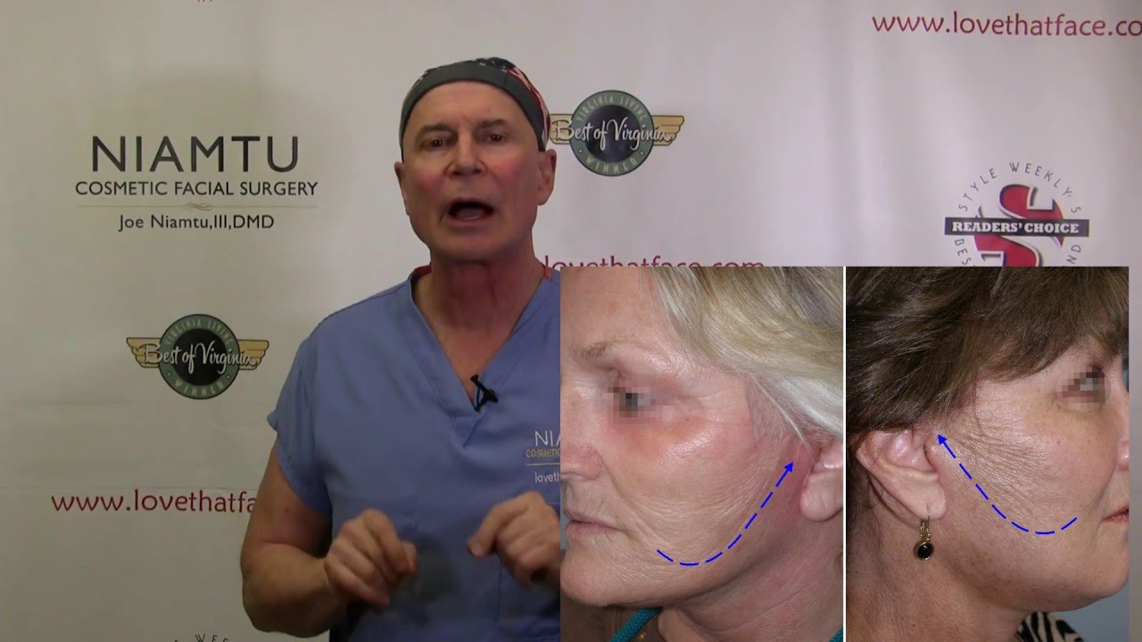 Avoiding Facelift Complications: Windblown Look, Pixie Earlobes, and ...