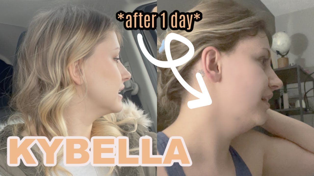 TRYING KYBELLA| Process & Day 1 Swelling* | 369 - YouTube