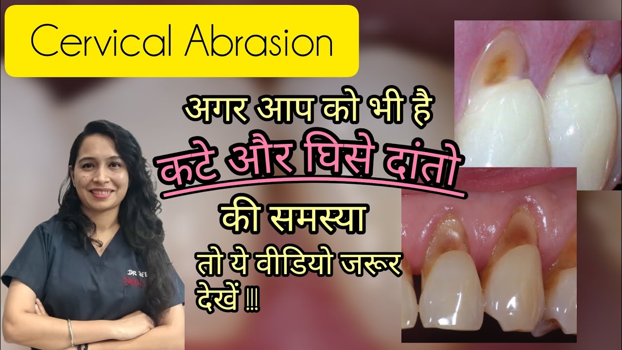 कटे और घिसे दांत || कारण और ईलाज || cervical abrasion || #sensitivity # ...