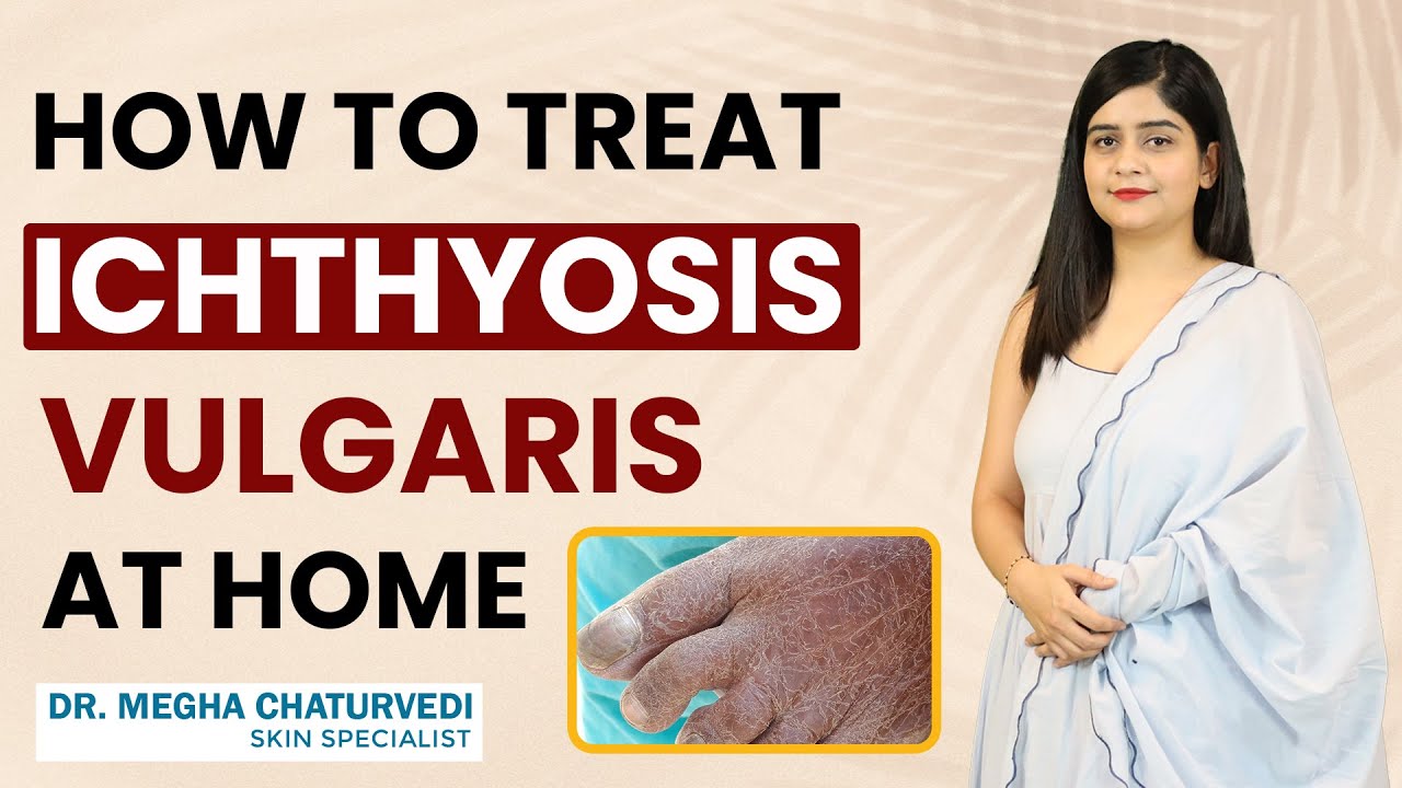 How to Treat Ichthyosis Vulgaris at Home | Home Remedies for Ichthyosis ...