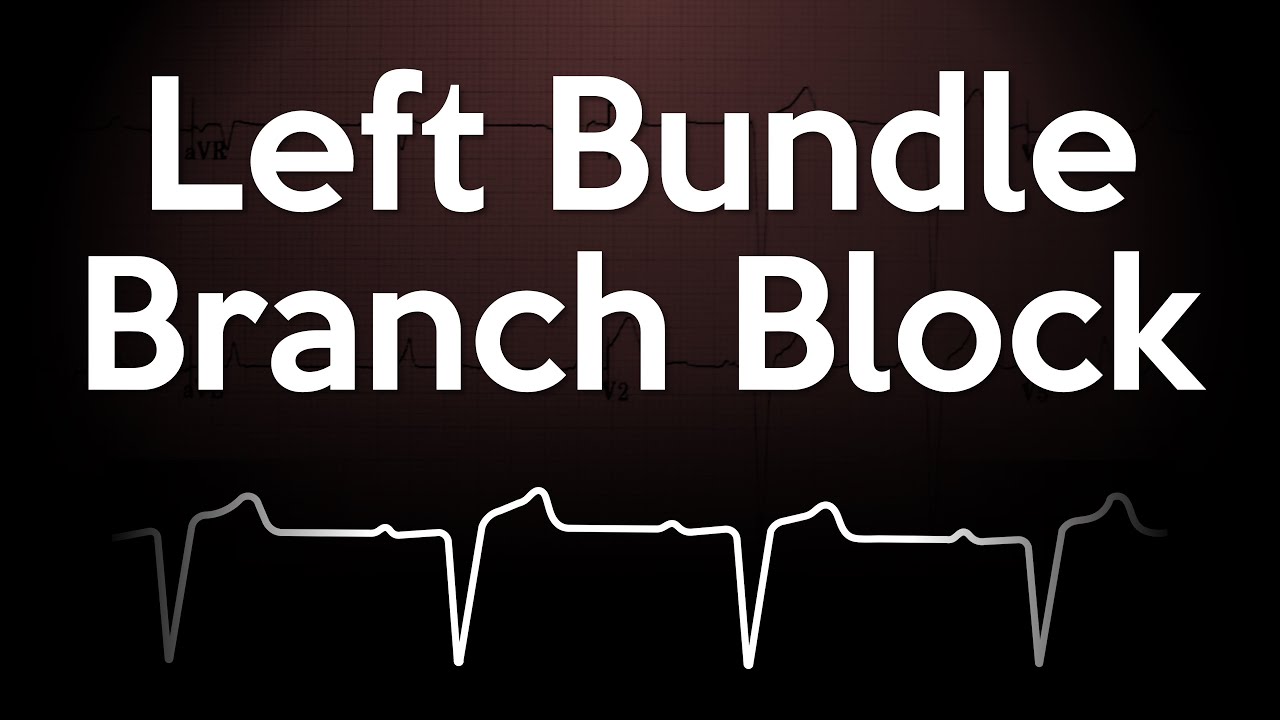 Left Bundle Branch Block ECG Explained - YouTube