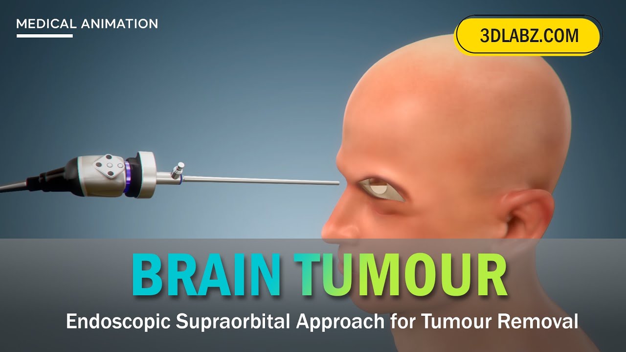 Brain Tumor Surgery 3D Animation | Endoscopic Supraorbital Approach ...