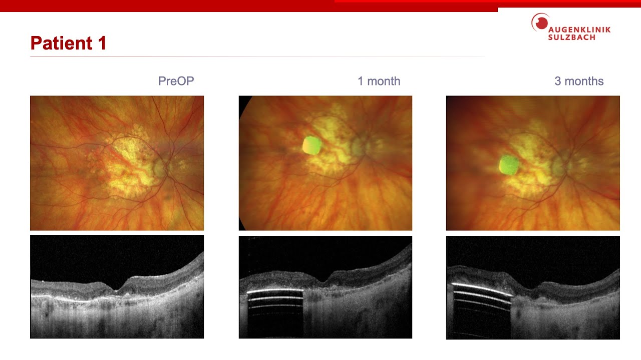 Subretinal Bionic Prosthesis for Geographic Atrophy in AMD - First ...