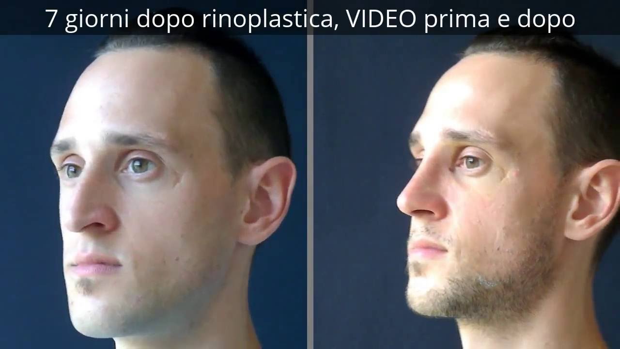Rinoplastica Andata Male Prima E Dopo Rinoplastica Effetti Collaterali